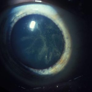 Les signes de la cataracte les plus fréquents